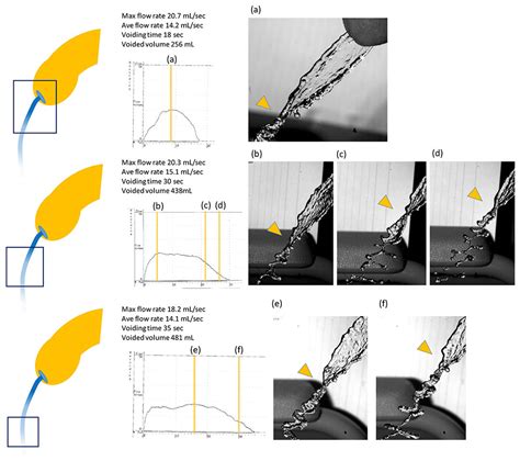 Ics 2019 Abstract 526 Observation Of Vorticity In Evacuated Urine Stream From Male Urethra