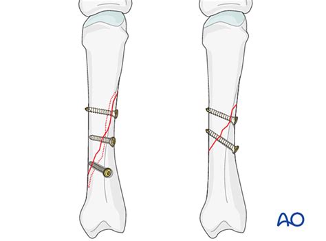 Lag Screw Fixation For Simple Oblique Fracture Of The Diaphysis
