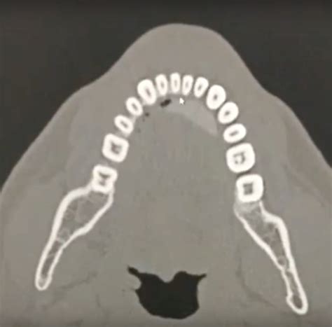 Hérnia De Uncus Sir Serviços E Residência Médica Em Radiologia