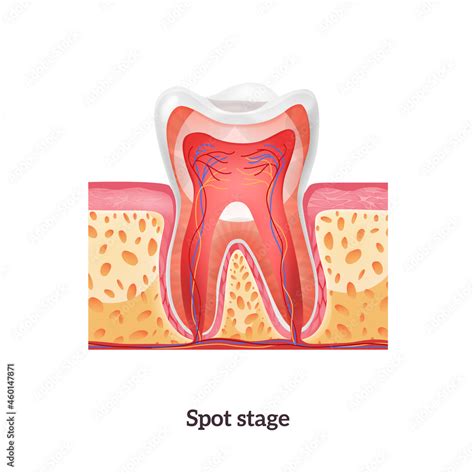 Realistic Caries Tooth Anatomy Stock Vector Adobe Stock