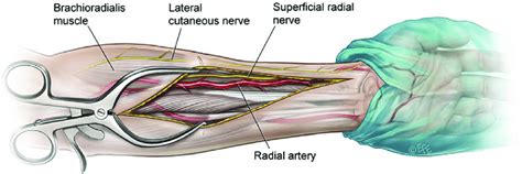 Radial Artery
