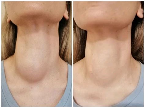 Cem Yucel On Linkedin Six Months After Thyroid Nodule Microwave Ablation