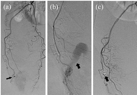 A 71 Year Old Female Patient With Massive Lower Gib A Ima Download Scientific Diagram
