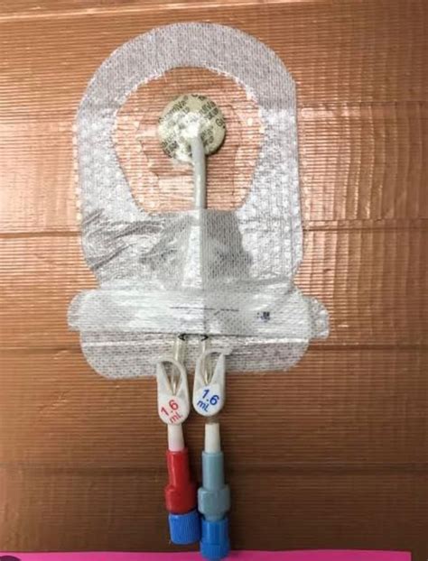 Permcath Care By Patient👉 🙏once A Permcath Is Put In Place The Patient