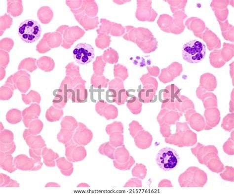 Human Blood Smear Leukocytosis Acute Infection Foto Stok 2157761621