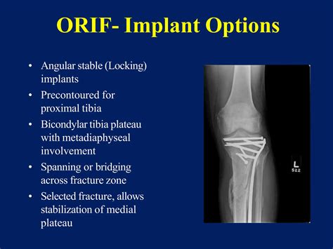 Proximal Tibia Fractures And Its Management Pptx Proximal Tibia Fractures And Its Management Pptx