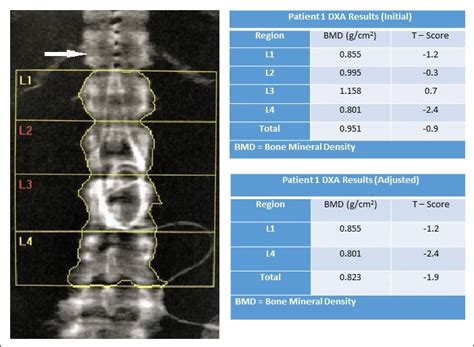 Dxa Dual Energy X Ray Absorptiometry Results Of Patient 1 With An