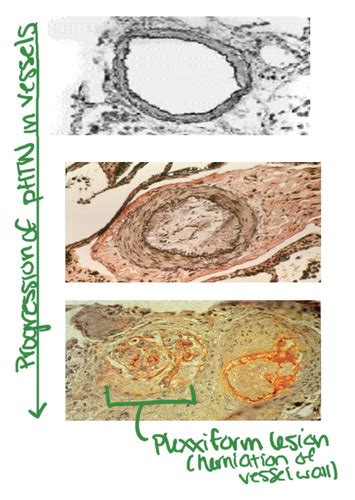 5 23 Pulmonary Htn Flashcards Quizlet