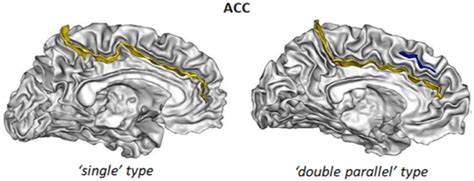 Example Of Different Acc Sulcal Patterns The “single Type” With Only Download Scientific
