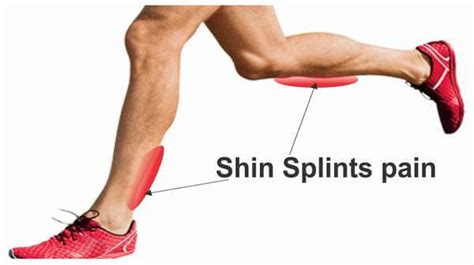 Shin Splints Common Causes Symptoms Treatment Preventions