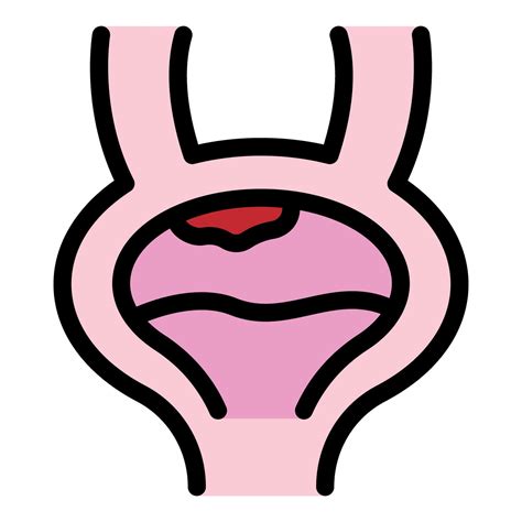 Bladder Polyp Showing Cancerous Cells Growing And Multiplying 55586573