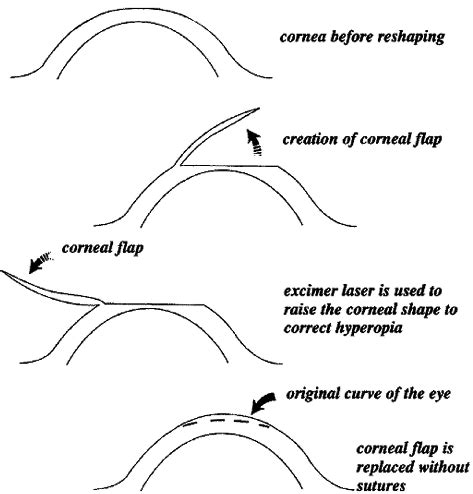 Refractive Errors In A Human Eye Download Scientific Diagram