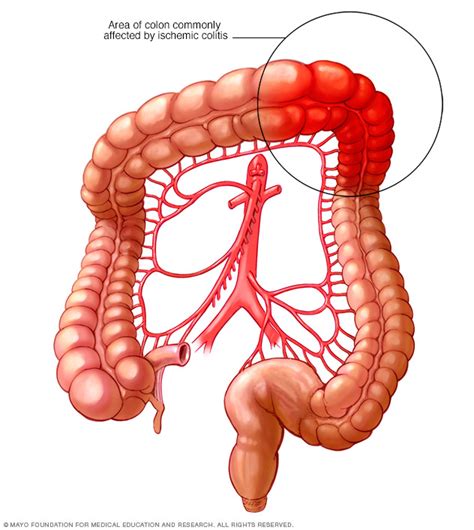 Ischemic Colitis Disease Reference Guide