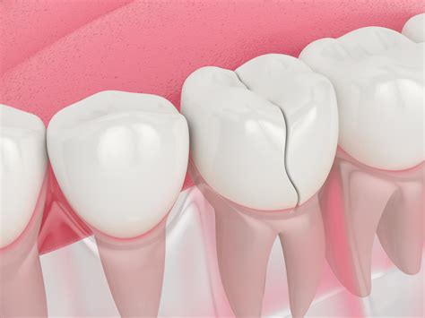 Vertical Tooth Fractures Newbury Park Dentist