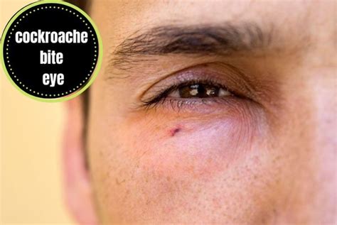 Cockroach Bite Eye Symptoms Causes Prevention And Treatment The