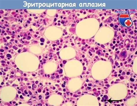 Механизмы развития патогенез эритроцитарной аплазии