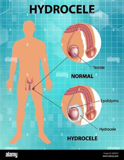 Medical Poster Showing Different Between Male Normal Testicle And