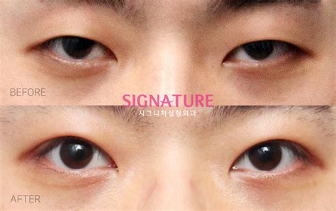 무쌍눈매교정 전후사진 시그니처성형외과