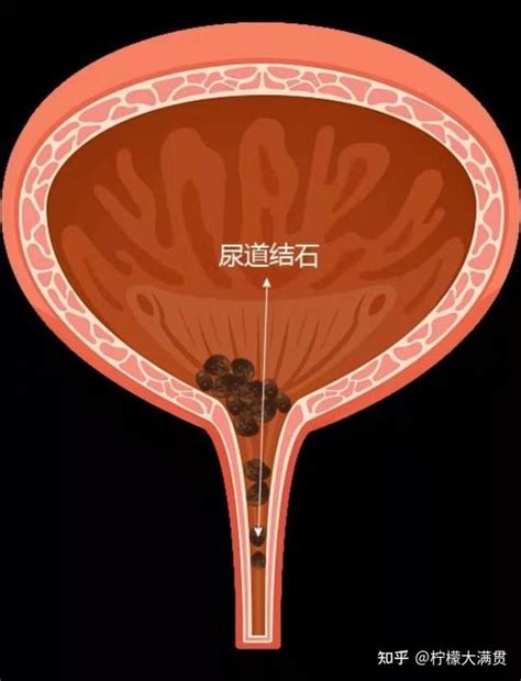 尿结石有哪些症状表现 知乎