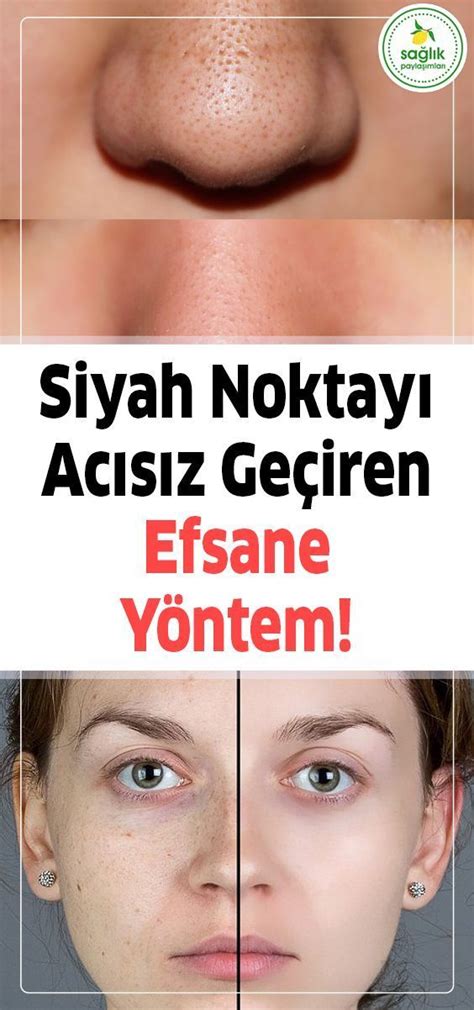 Siğil Ben Siyah Nokta Ve Yaşlılık Lekelerini Yok Edin Ben Edin
