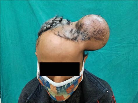 Cerebriform Congenital Melanocytic Nevus Of The Scalp Treated With The Help Of Tissue Expansion