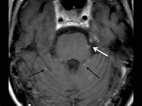 Trigeminal Nerve Evaluation With Magnetic Resonance Imaging Semantic Scholar