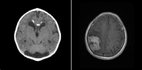 Figure 1 From Dcgan Based Data Augmentation For Improving Cnn Performance In Meningioma