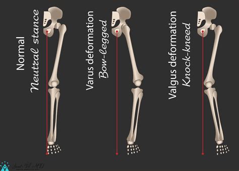 Medical Poster Normal Legs Varus And Valgus Deformity Of The Legs