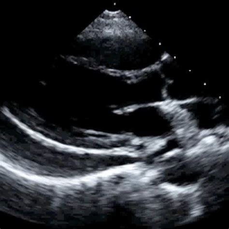 Lvad Training Lvad Ultrasound Lvad Echocardiography