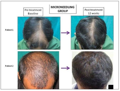 Vellus Hair To Terminal Hair Hair Growth Cycle Guide Hairguard