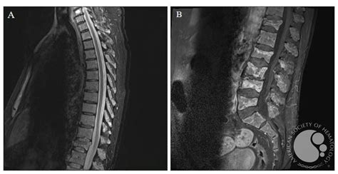 Multiple Myeloma Mri