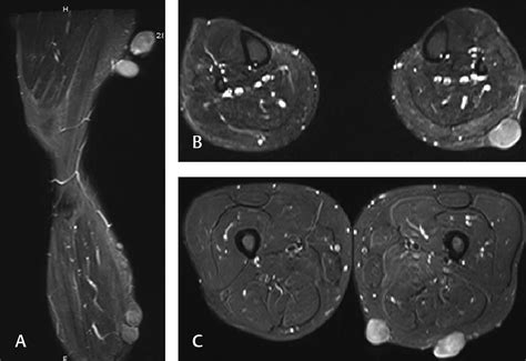 Segmental Neurofibromatosis Journal Of Neurosciences In Rural Practice