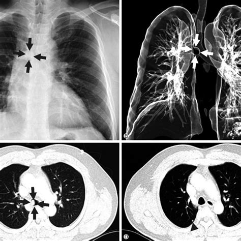 The Post Operative Bronchoscopy And 3d Airway Ct At 2 Years After