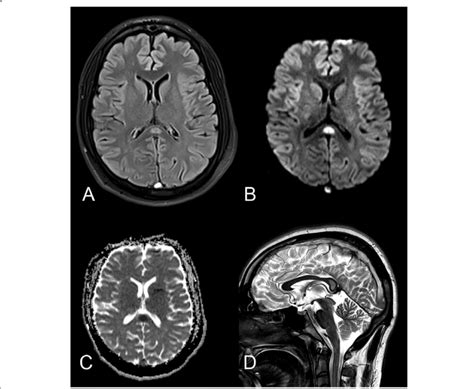 Well Defined Focal Hyperintense Lesion Was Seen In The Splenium Of The Download Scientific