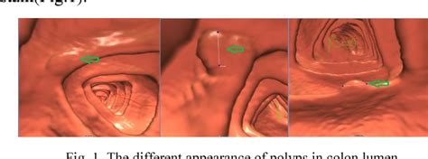 Figure 1 From A Novel Computer Aided Detection Cade Scheme For Colonic Polyps Based On Colon