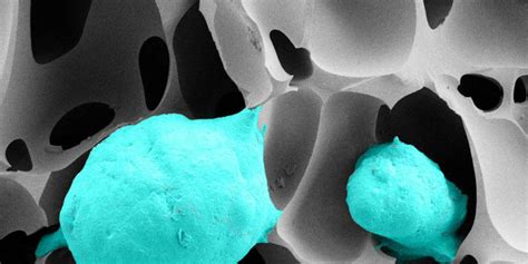 Three Dimensional Model For Prostate Cancer Research Being Developed Medical Design And