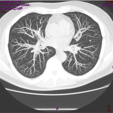 Ct Image Showing Centrilobular Nodular Opacities In The Left Lower Lobe Download Scientific