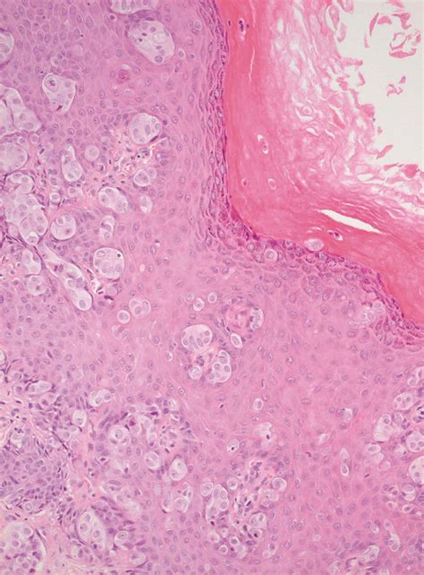 Vulval Pagets Disease Obgyn Key