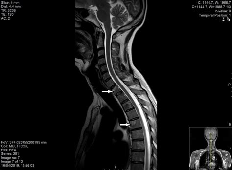Atypical Marantic Endocarditis Pmc