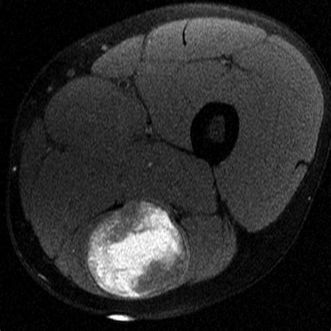 Imaging Features Of Primary And Secondary Adult Rhabdomyosarcoma Ajr