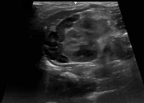 Ambiguous Genitalia Ultrasound