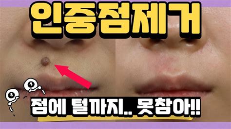 인중점제거 점에 난 털까지 한번에 제거 Youtube