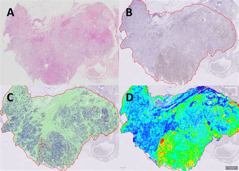 A Hes Stained Wsi B Ihc Stained Wsi Ki 67 With Manually Delineated