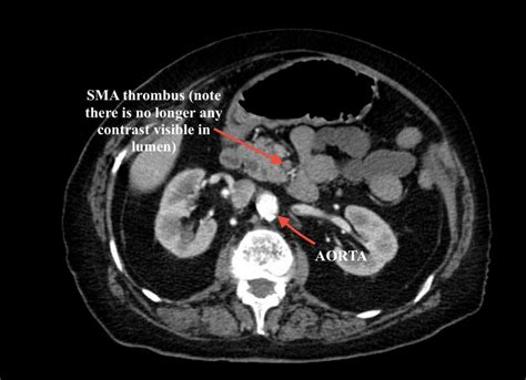 Superior Mesenteric Artery Axial Ct Annotated Jetem 2018 Jetem