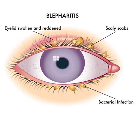 Patient Zone Blepharitis Explained
