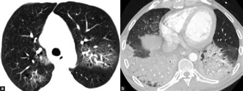 A Systematic Approach To Interpretation Of Heterogeneous Lung