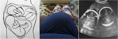 Identical Twin Positions