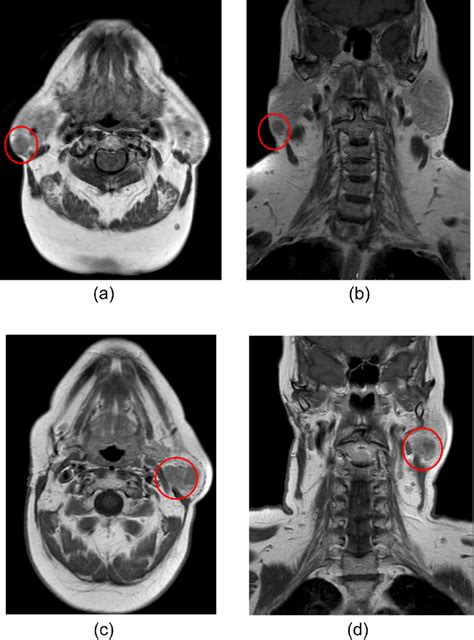 A Ideal Case For Extracapsular Dissection Due To The Superficial