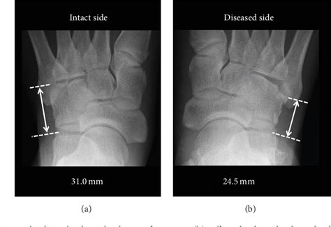 Nutcracker Fracture At Robin Alexander Blog