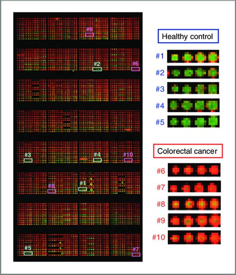Representative Reverse Phase Protein Microarray Slide Of The V1 Cohort